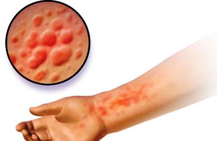 Strongiloidiasis, Penyakit Kecacingan yang disebabkan oleh ...