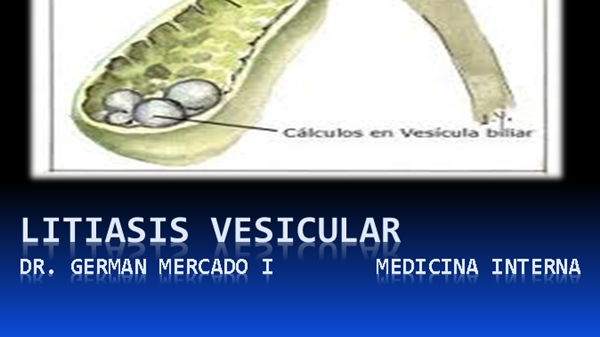 Medicina III - Litiasis Vesicular | USMP FN Archivos