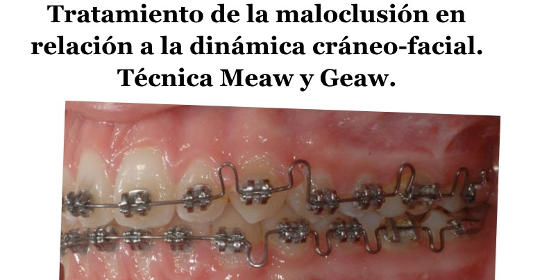 IV Curso Teórico-Práctico Ortodoncia de las funciones: Tratamiento de ...