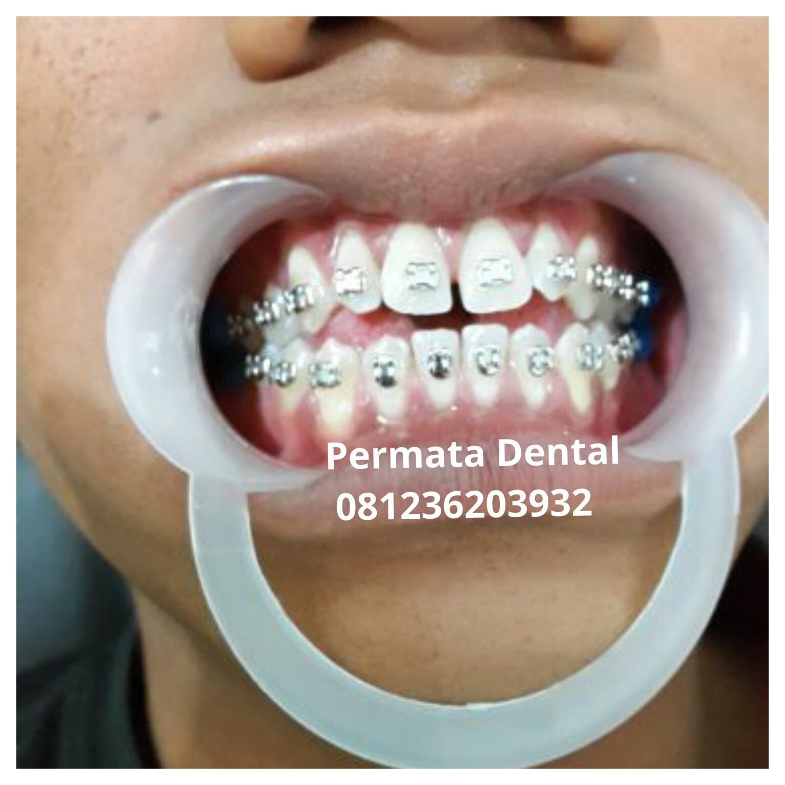 DOKTER GIGI BALI: Behel | Barcket | Kawat Gigi Perawatan