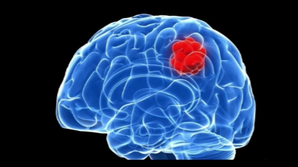 Brain tumors: Symptoms, Signs, Types, Causes, Treatments, and Survival ...