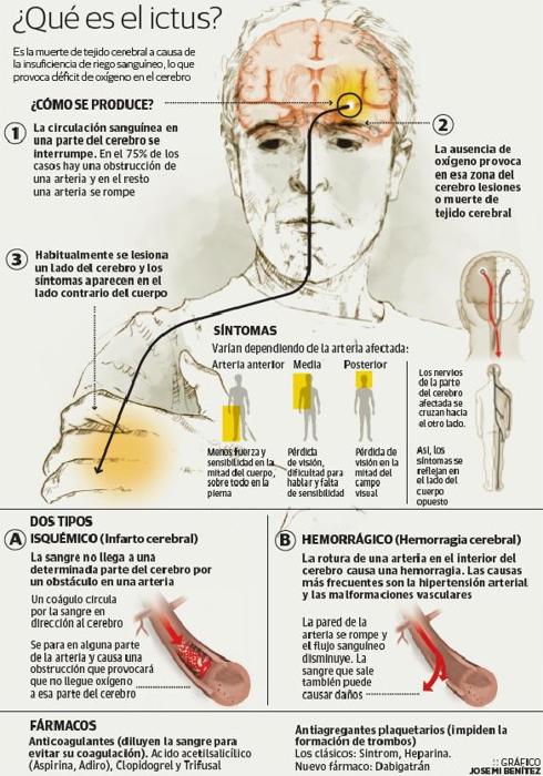 Aprender con una imagen (Guía práctica con Infografías y Gifs) : Ictus