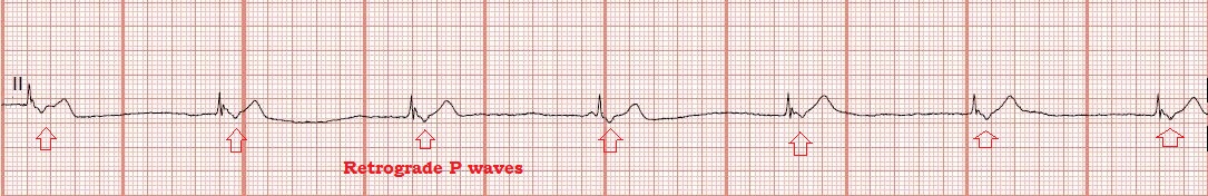 EKG Rhythm Strip Quiz 84