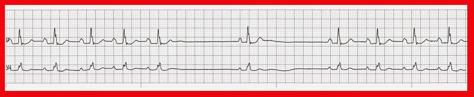 Practice EKG Strips 378