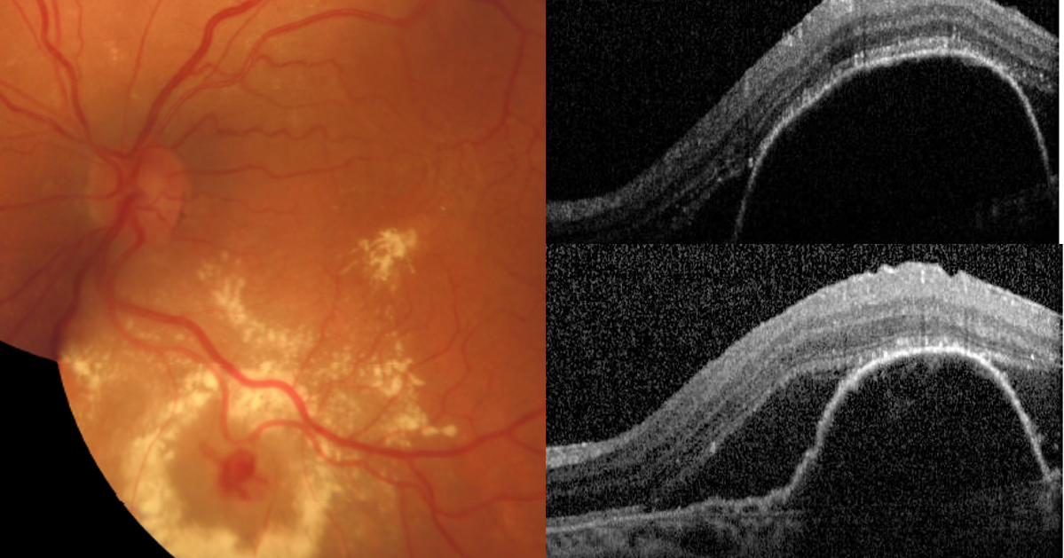 Retina e Catarata - Fortaleza: OCT de Mácula