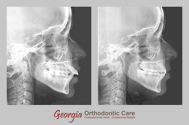 GEORGIA ORTHODONTIC CARE - LAWRENCEVILLE & NORCROSS GA: November 2013