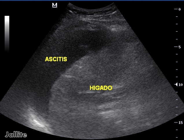 Ascitis Por..