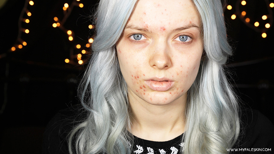 My Pale Skin: Acne Coverage, Valentines Day Make Up Tutorial!