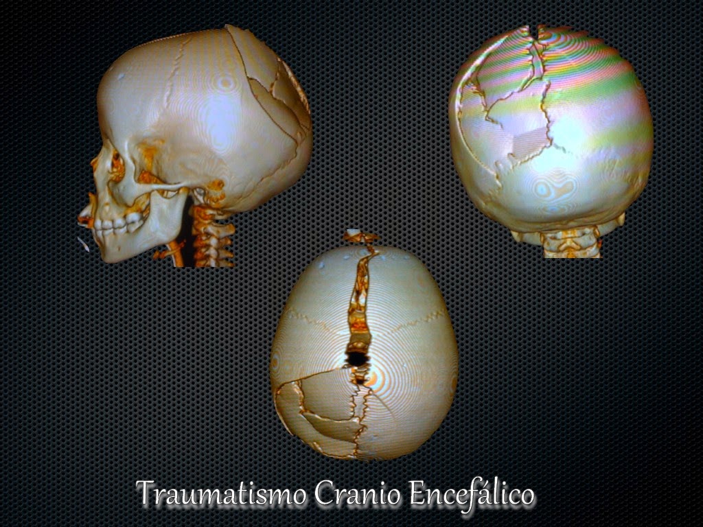 Cid De Traumatismo Craniano - RETOEDU