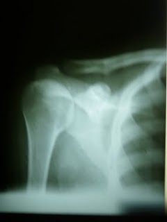 rayos x 2011: CLAVICULA Proyeccion Axial