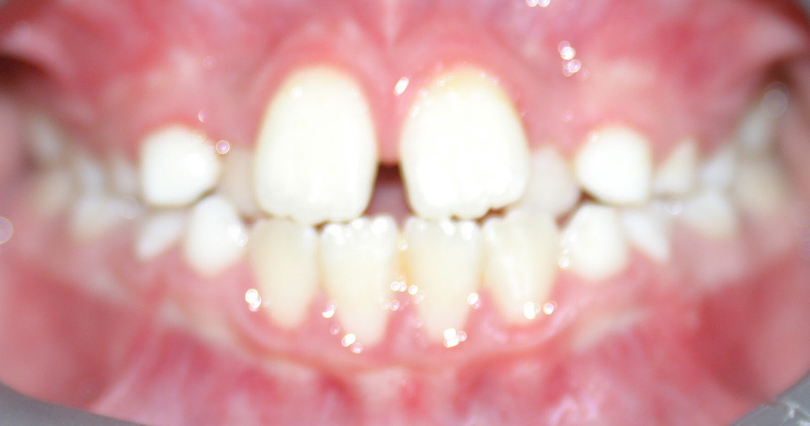 James R. Waters, DDS, MSD, PA: When is it best to fix an Underbite?