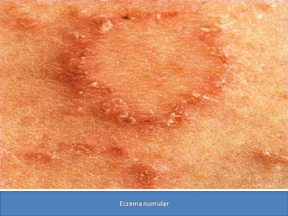 Pitiriasis Rosada de Gibert