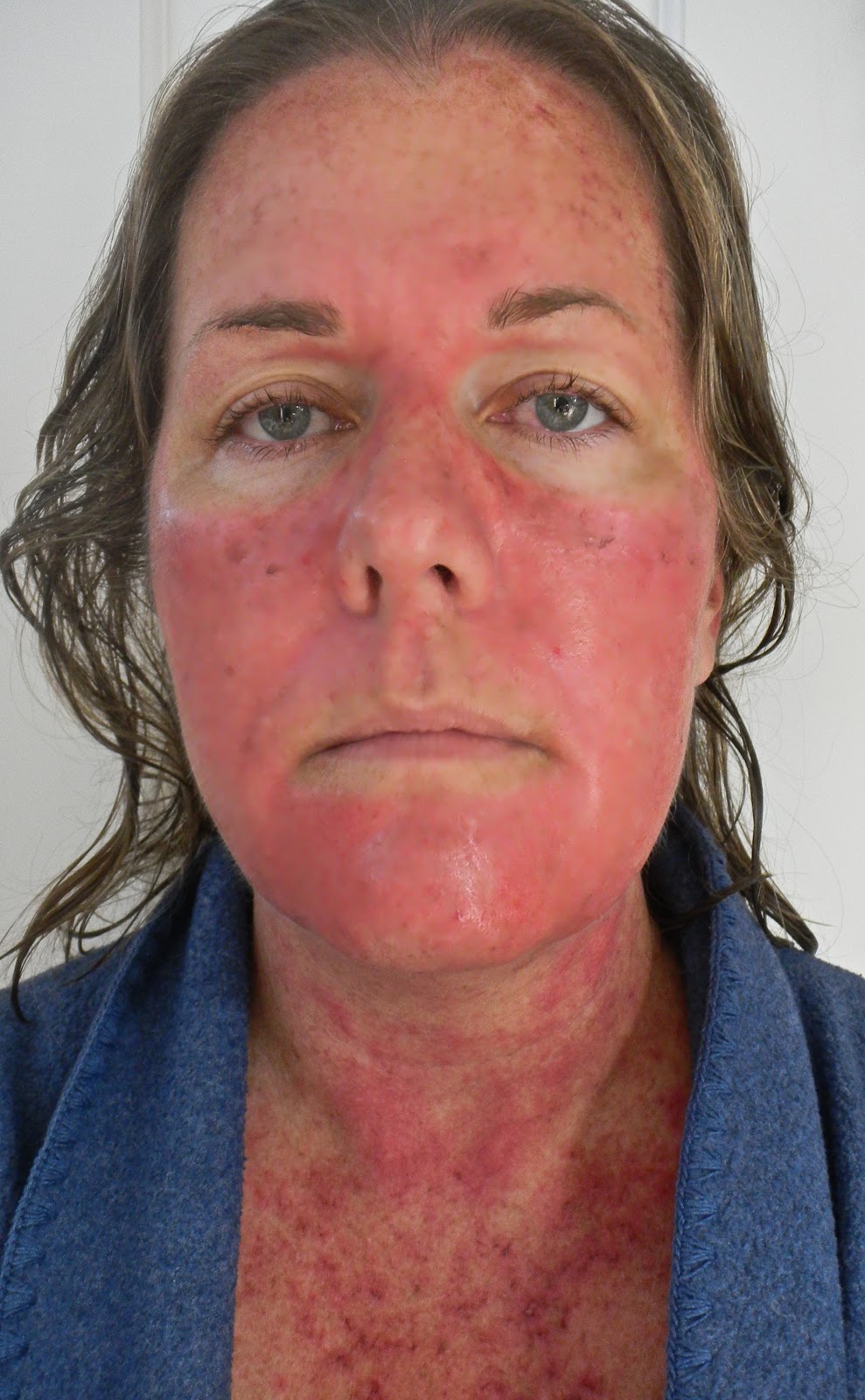 Efudex and Me 2013: Efudex Day Sixteen