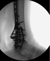 Case of the Month: Fracture cases at Harborview Medical Center ...