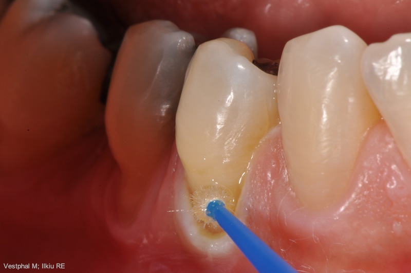 M. Vestphal - Odontologia Estética: Restauração Classe V com Resina ...