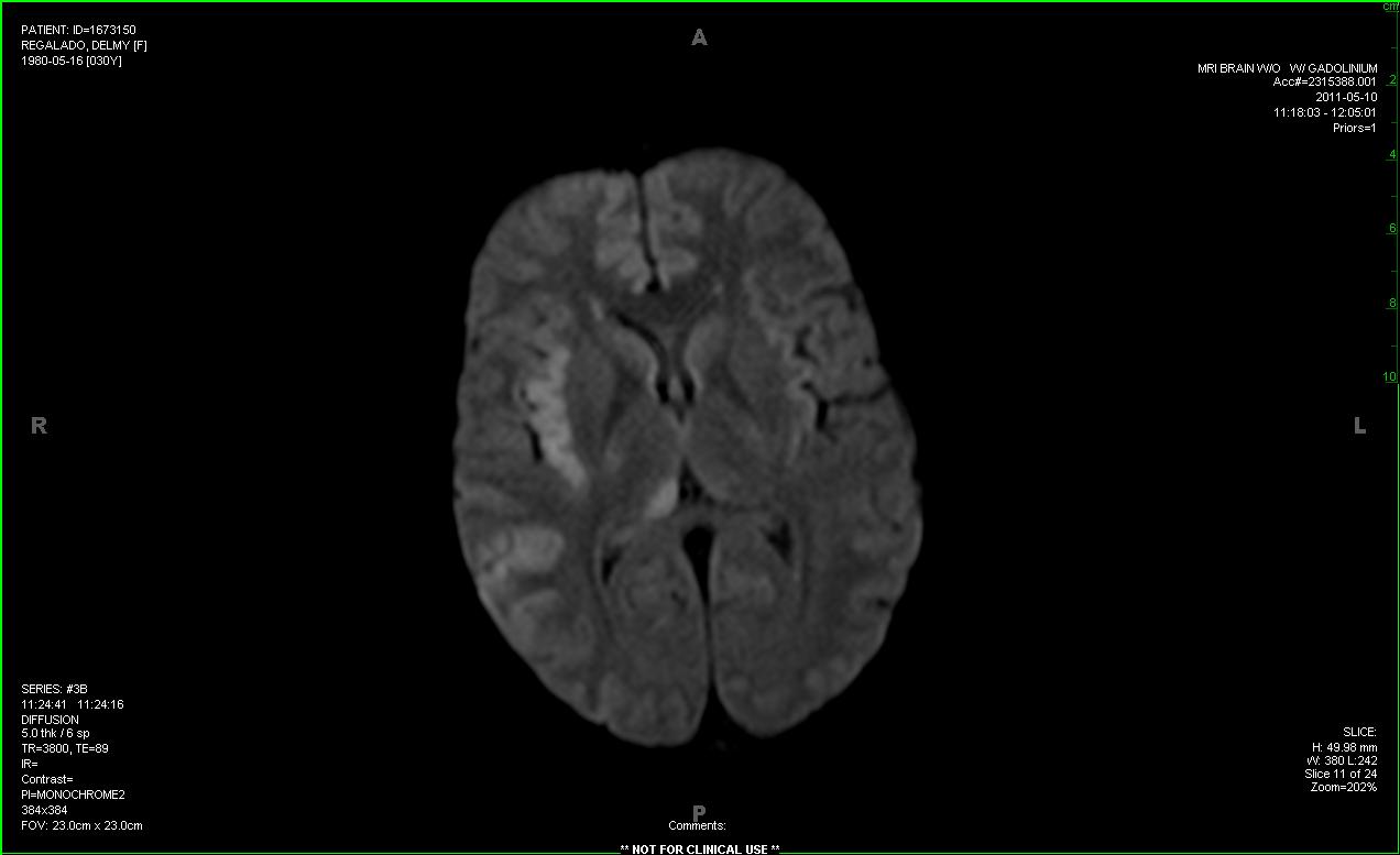 Image Bank: Status epilepticus MRI findings