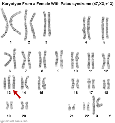 Trisomy 13