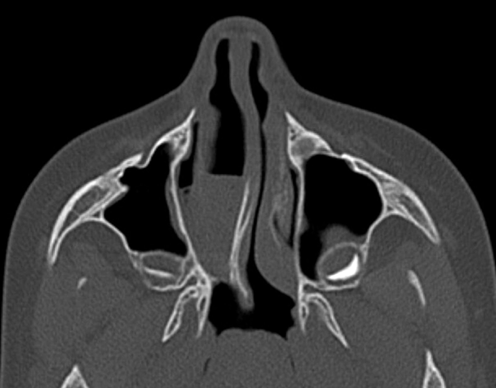 ENT for medical students: NOSE - Congenital