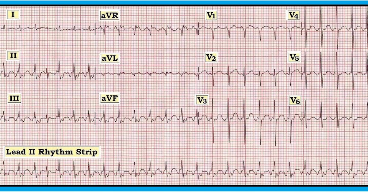 ECG Interpretation: ECG Interpretation Review #40 (Regular SVT - List 1 ...