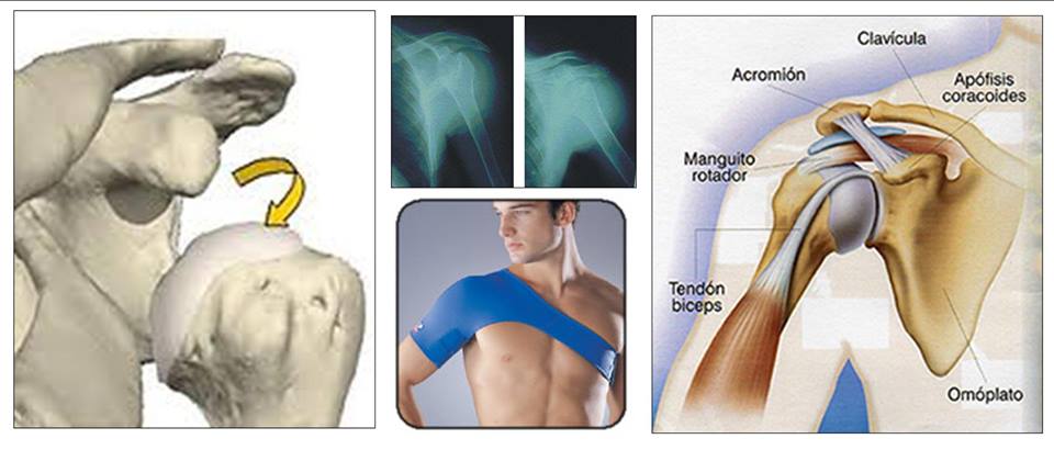 INESTABILIDAD DE HOMBRO ~ CorpoMech