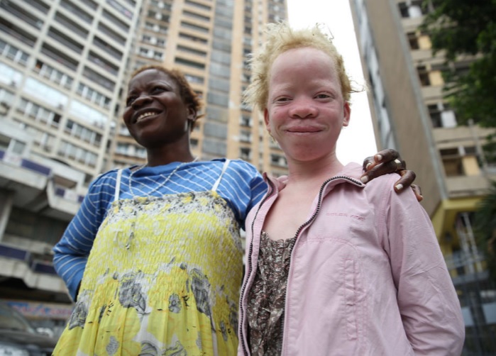 Albino too white to be a human being