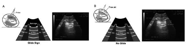 Thoracic Focused Assessment with Sonography for Trauma (TFAST)