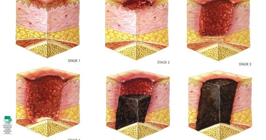ER goldbook: Pressure injury