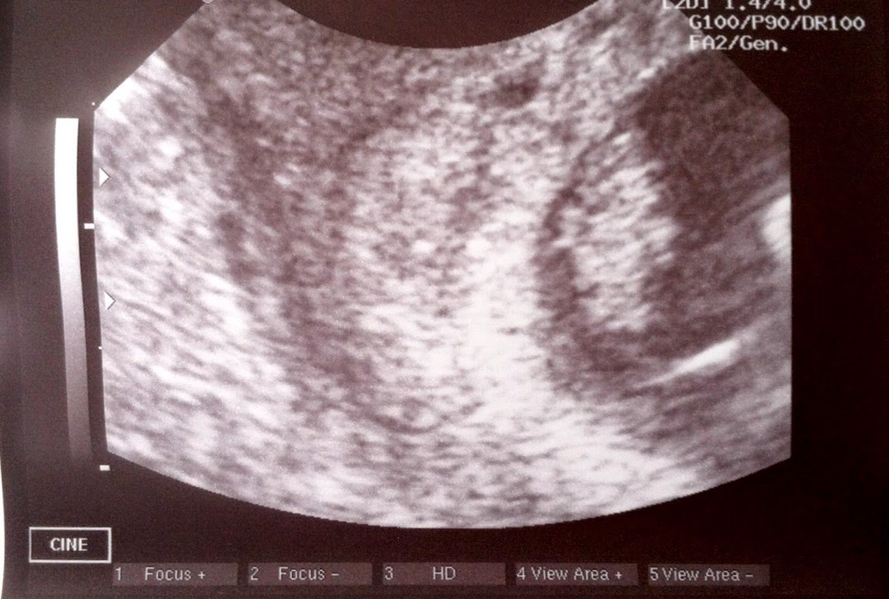 From Fertile Myrtle to Infertile Myrtle: May 2014