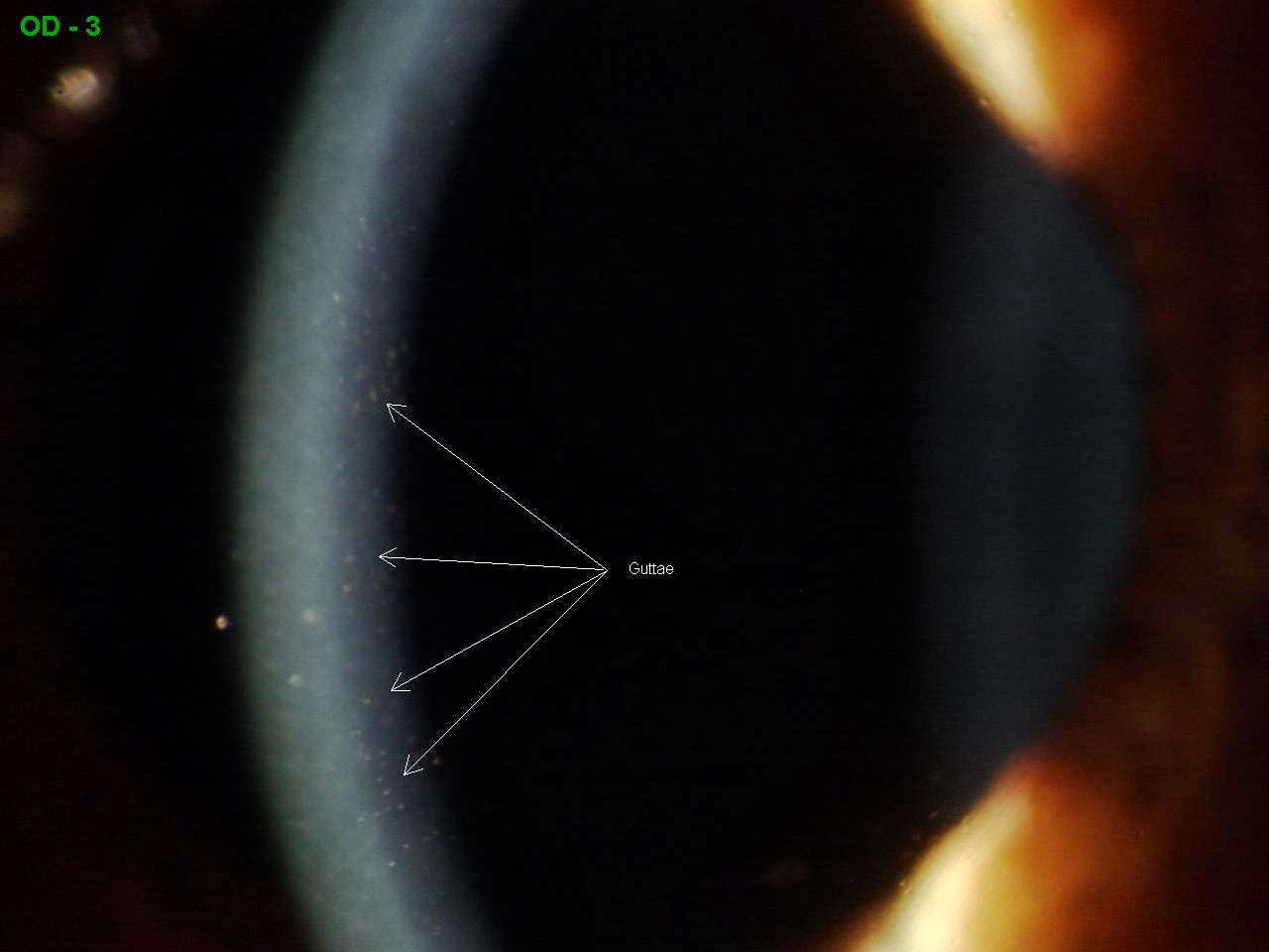Sonoran Desert Eye Center: GUTTAE