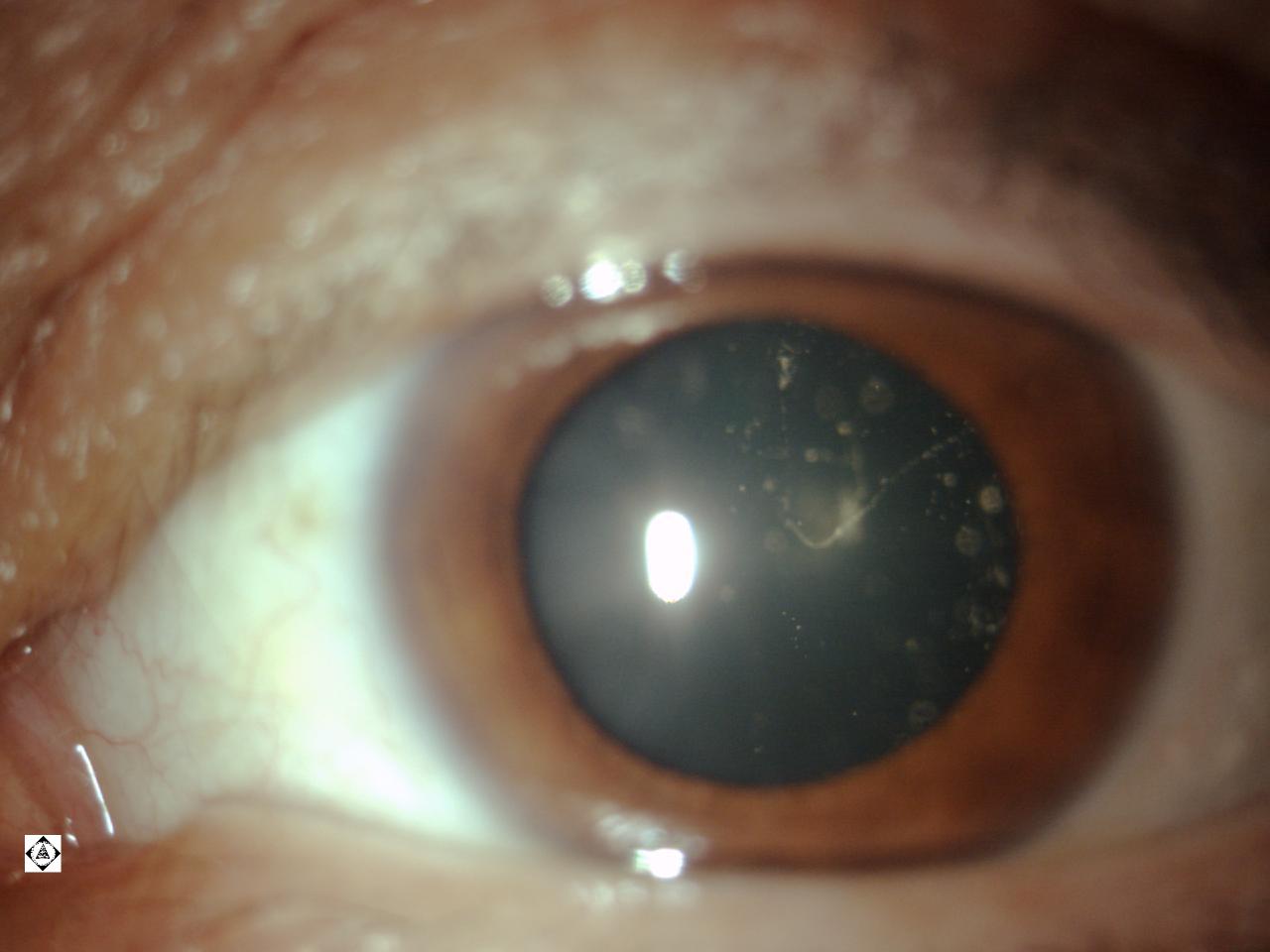 Sonoran Desert Eye Center: ASTEROID HYALOSIS