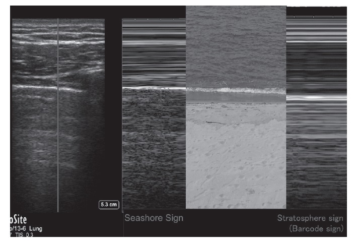松下 ER ランチ・カンファレンス: Lung sliding