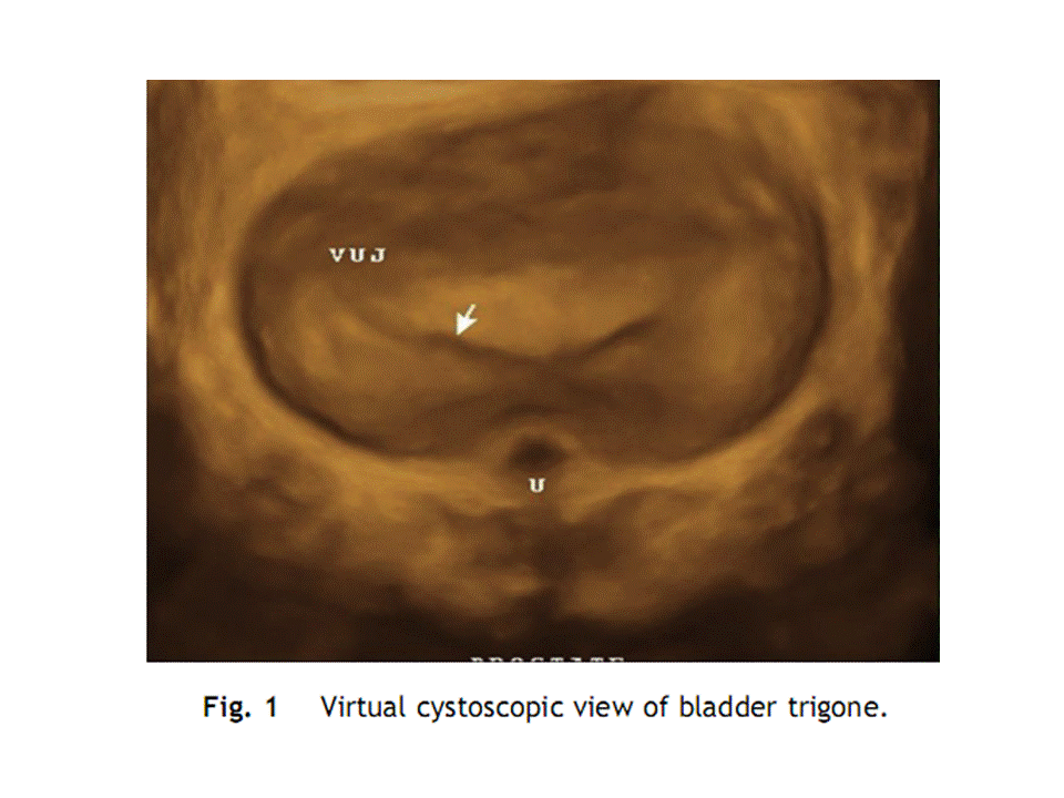 BÀI SOẠN VỀ SIÊU ÂM CHẨN ĐOÁN: VIRTUAL CYSTOSCOPY USING 3D ULTRASOUND