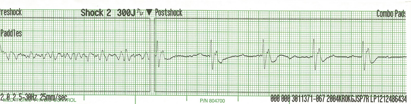 Pulseless VF/VT Part 3