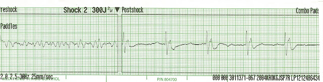 Float Nurse: Pulseless VF/VT Part 3