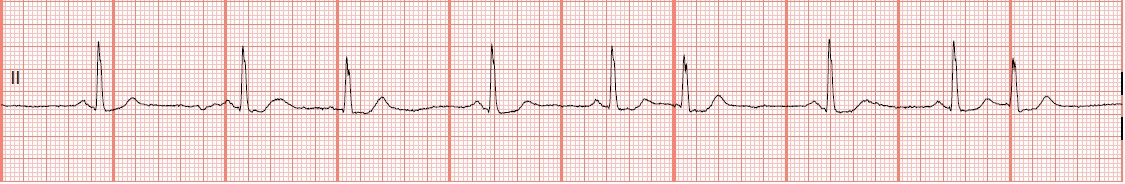 EKG Rhythm Strip Quiz 37