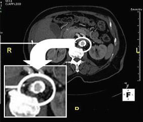 Vascular Mind : CT ANGIOGRAPHY APPEARANCE OF GORE EXCLUDER. IT´S ZIG ...
