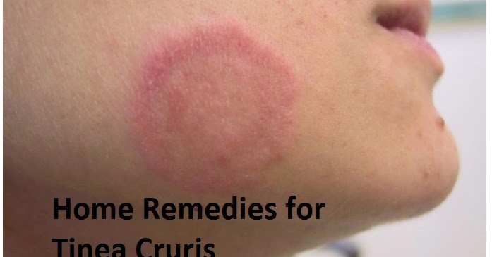 What Is Tinea Cruris? - Teroes