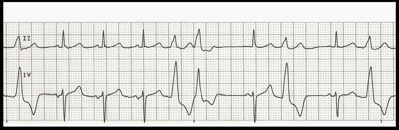 EKG Rhythm Strip Quiz 213