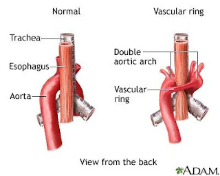 Amber's Surgery & Progress: What is a Vascular Ring?- Entry Number One