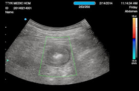 VIETNAMESE MEDIC ULTRASOUND: CASE 239: COLON TUMOR and WALLED-OFF ...