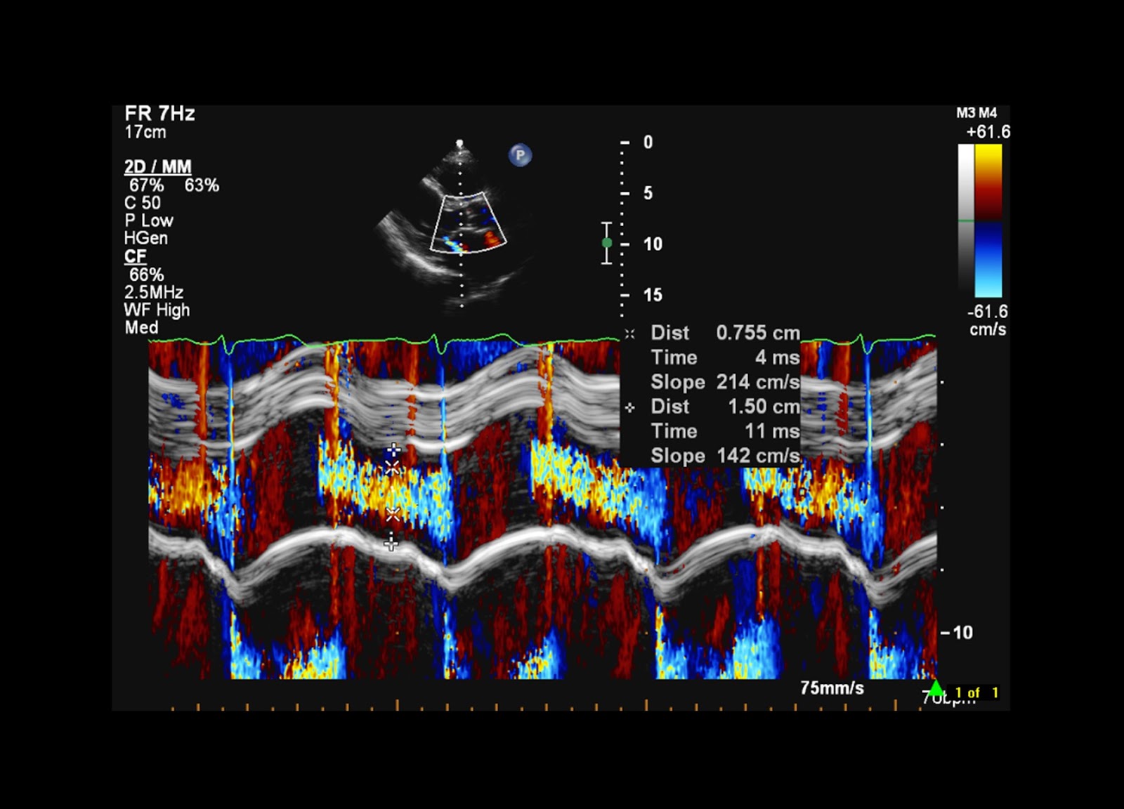 Andrew R Houghton 16 Eponymous Signs In Aortic Regurgitation andrew-r-houghton-16-eponymous-signs-in-aortic-regurgitation