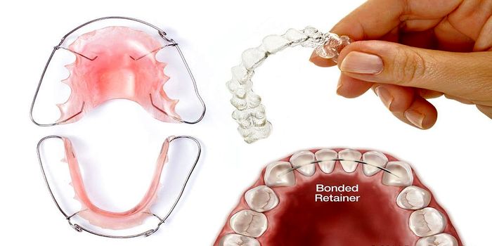 The Different Types Of Retainers - OdontoVida