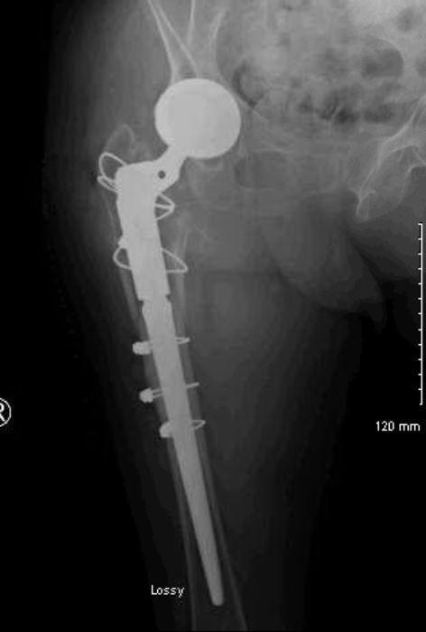 Interesting Topics in Orthopedic Surgery by Dr. Nasar: Periprostheric ...