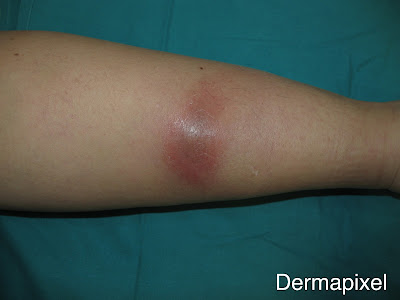 Dermapixel: marzo 2018