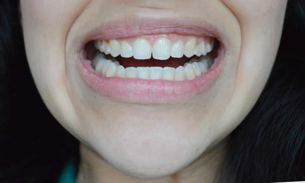 My Life with Invisalign