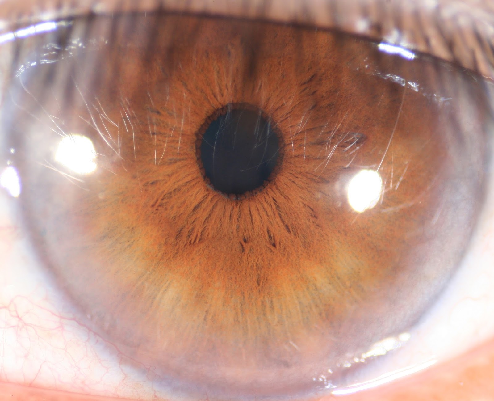 Modern & Multidimensional Iridology: Important iris Signs at IPB, Pupil ...