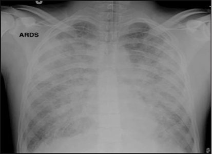 EM Didactic: ARDS: Rapid Review