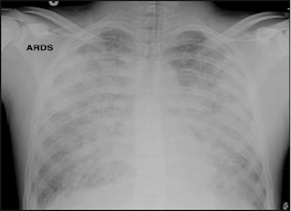 EM Didactic: ARDS: Rapid Review