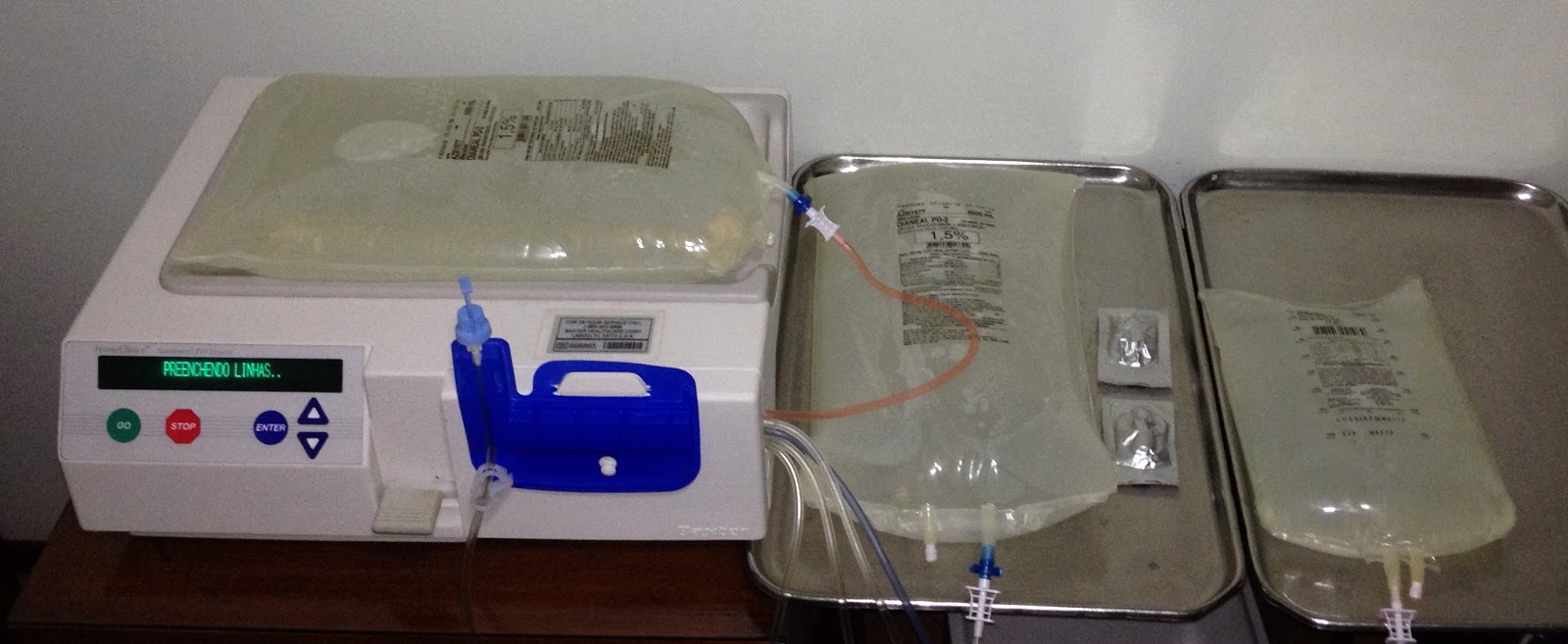 Diálise Peritoneal com icodextrina