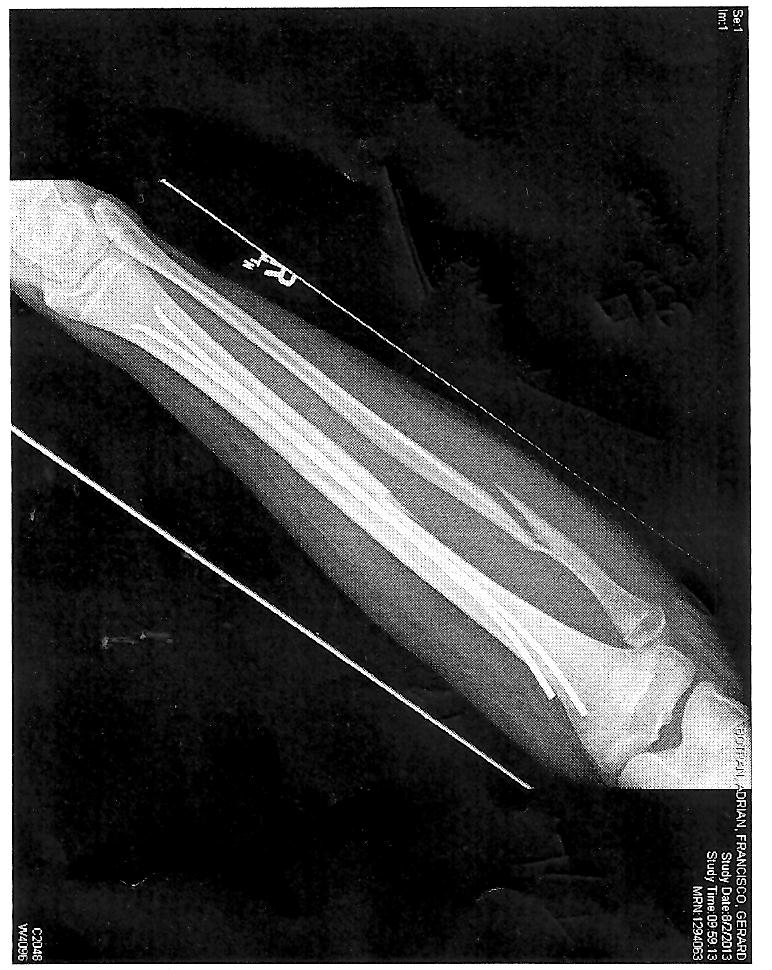 Inventor's Adventures: I broke my leg!